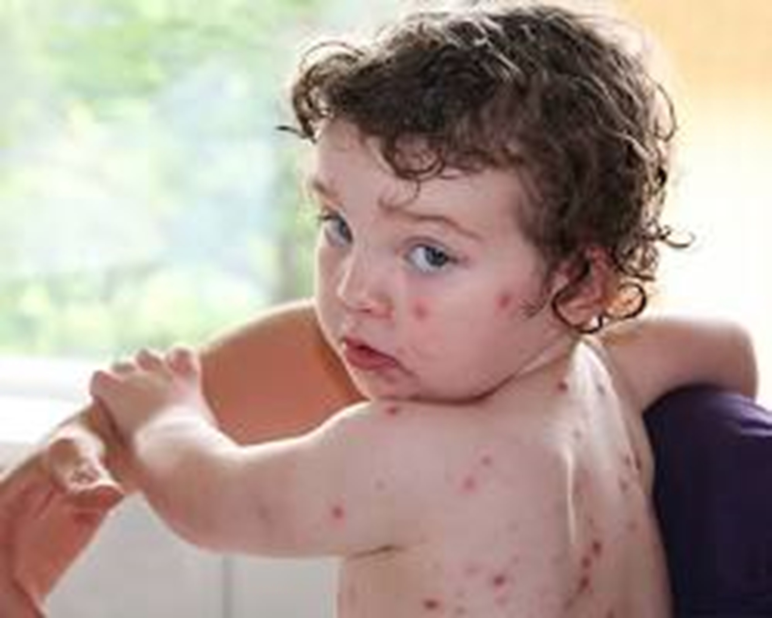 Chickenpox (Varicella):Causes, Symptoms, Prevention, and Treatment ...