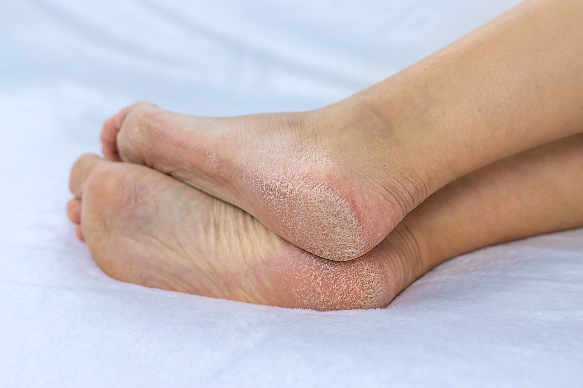 Cracked Heels: A Comprehensive Guide to Prevention and Treatment ...
