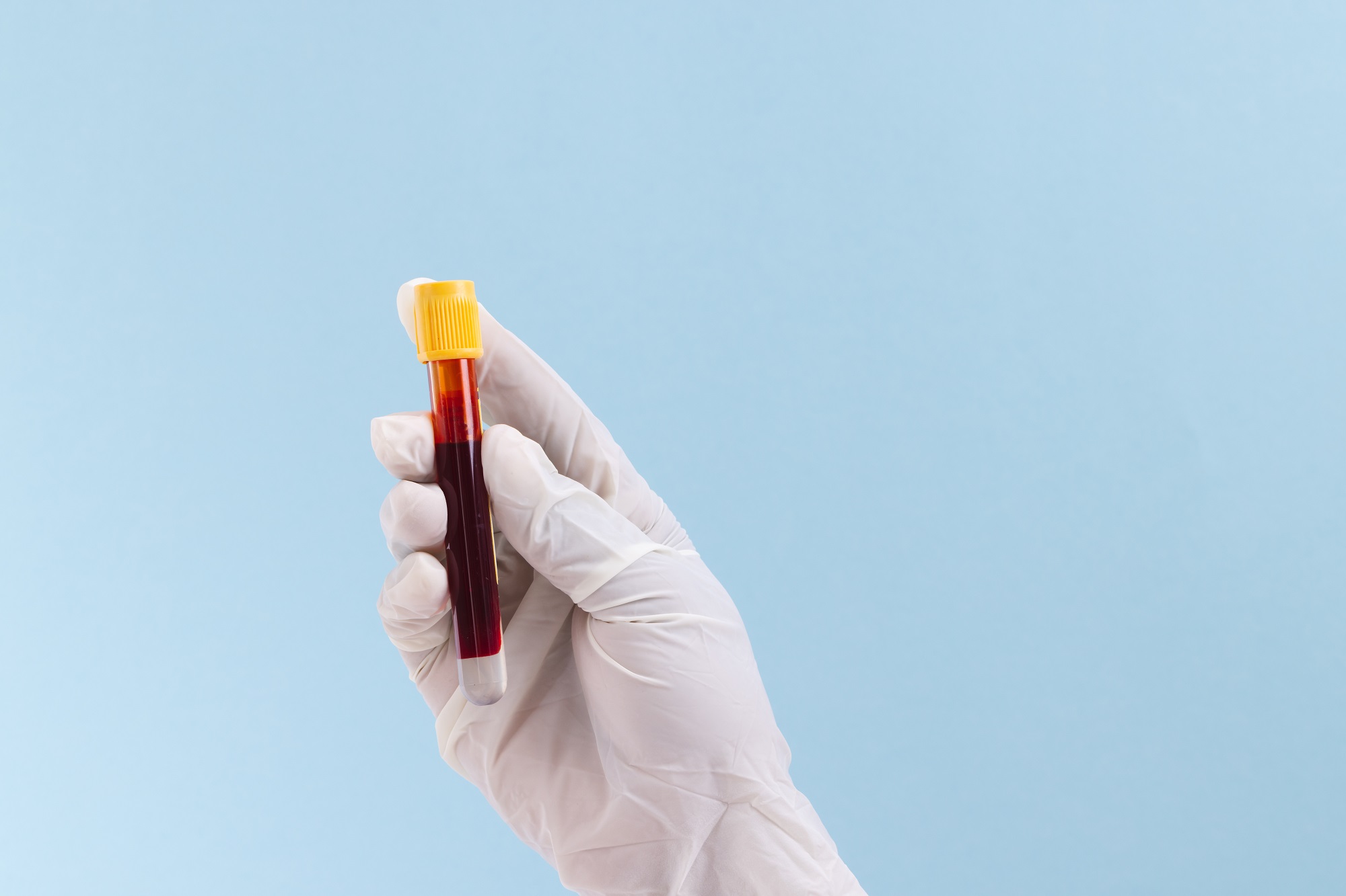 CRP Blood Test Near Me | C-Reactive Protein (CRP) Test at Home - Health ...