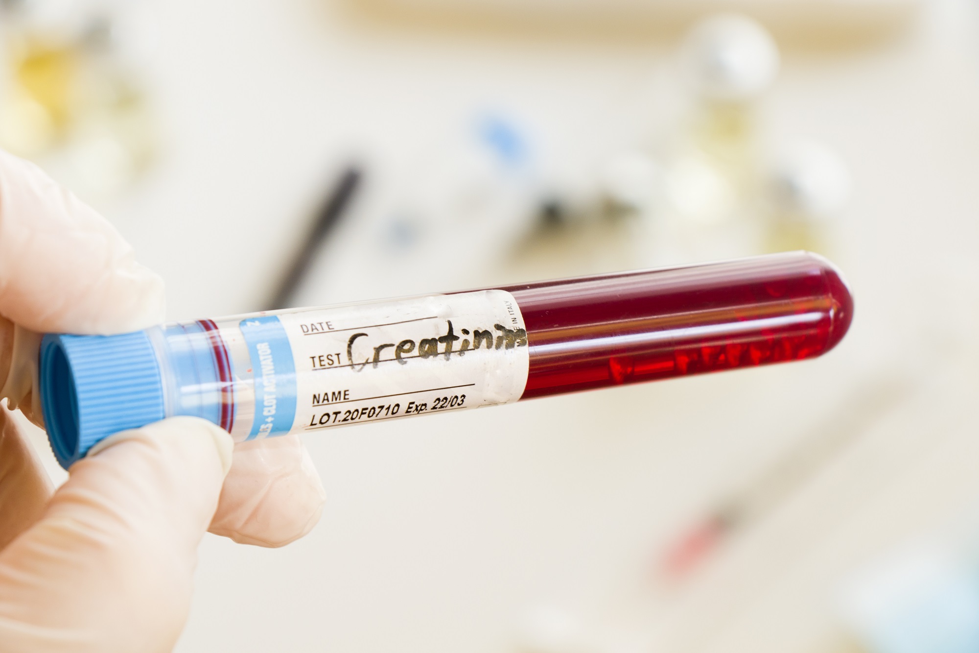 Demystifying the Creatinine Blood Test and Its Vital Role in Your ...