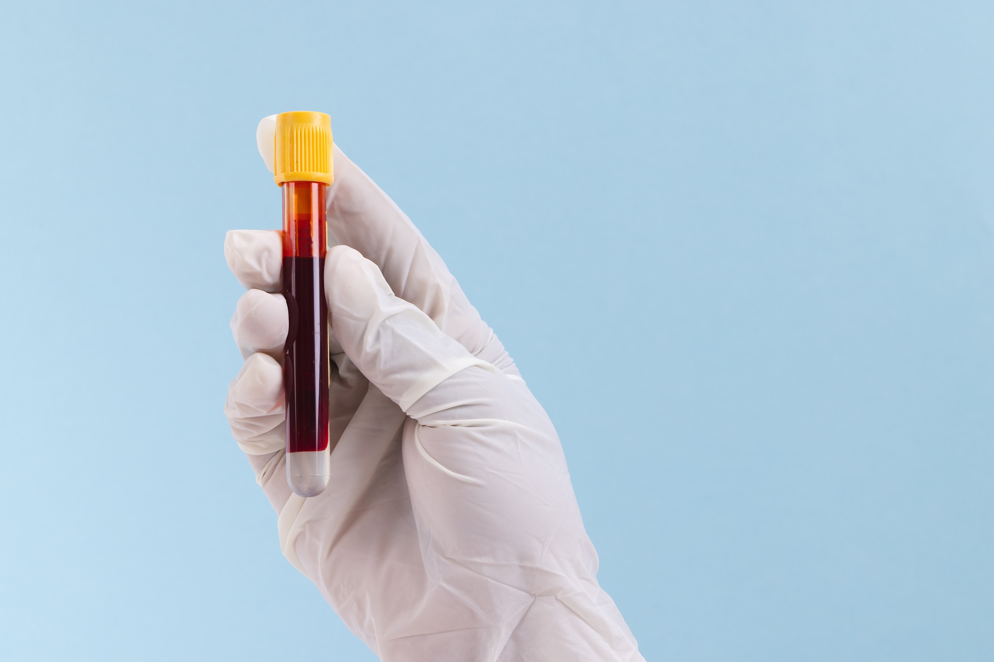 Uric Acid Blood Test at Home | Uric Acid Test Near Me: Understanding ...