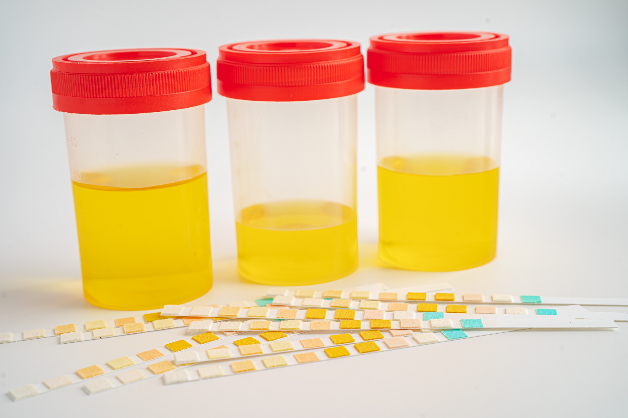 Urine Culture Test: Deciphering the Messages in Your Urine - Health ...