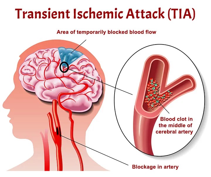 TIA (Transient Ischemic Attack): Symptoms, Causes, and Prevention Tips ...