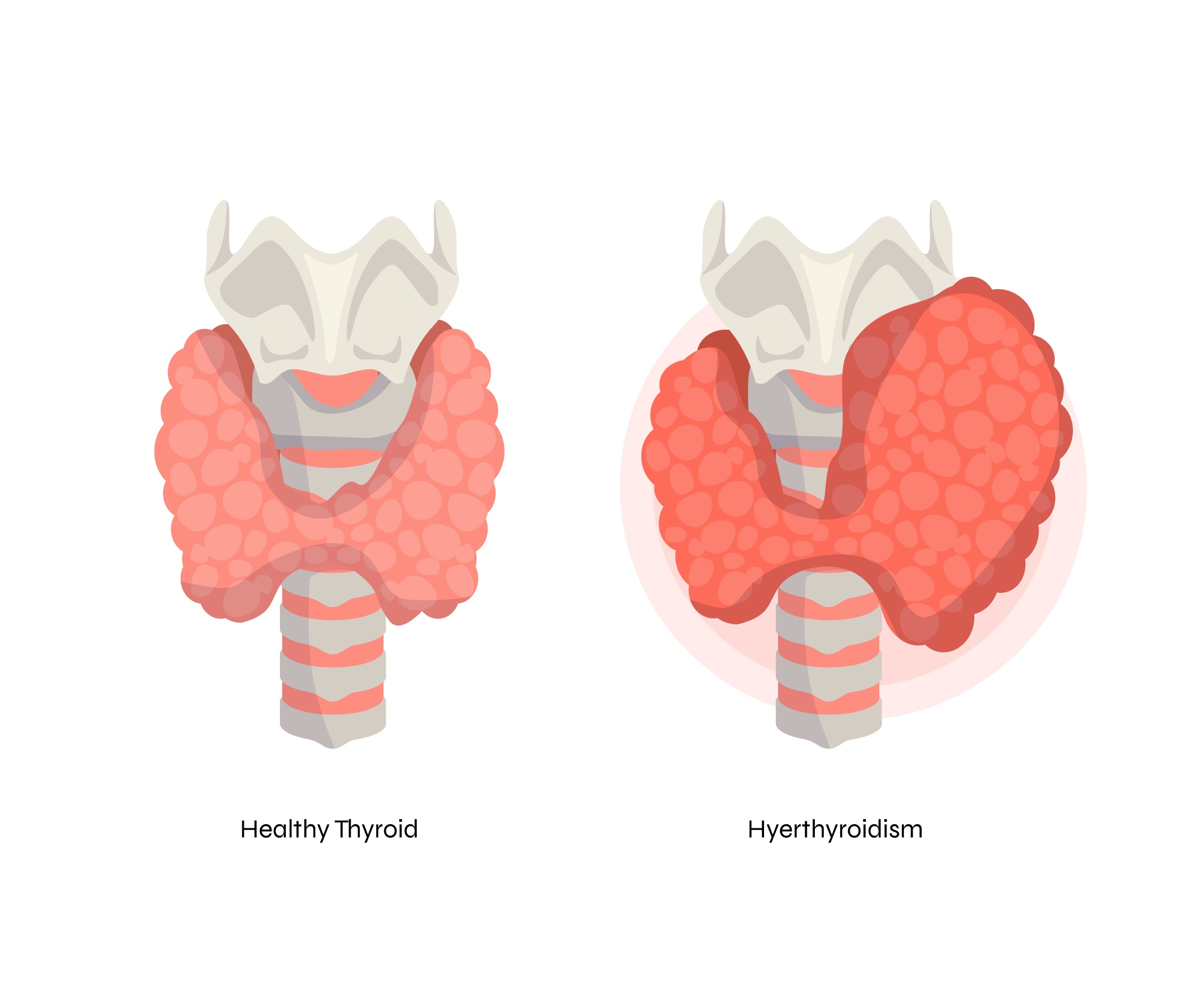 Thyroid: Symptoms, Causes, Prevention, and Treatment - Health Tips ...