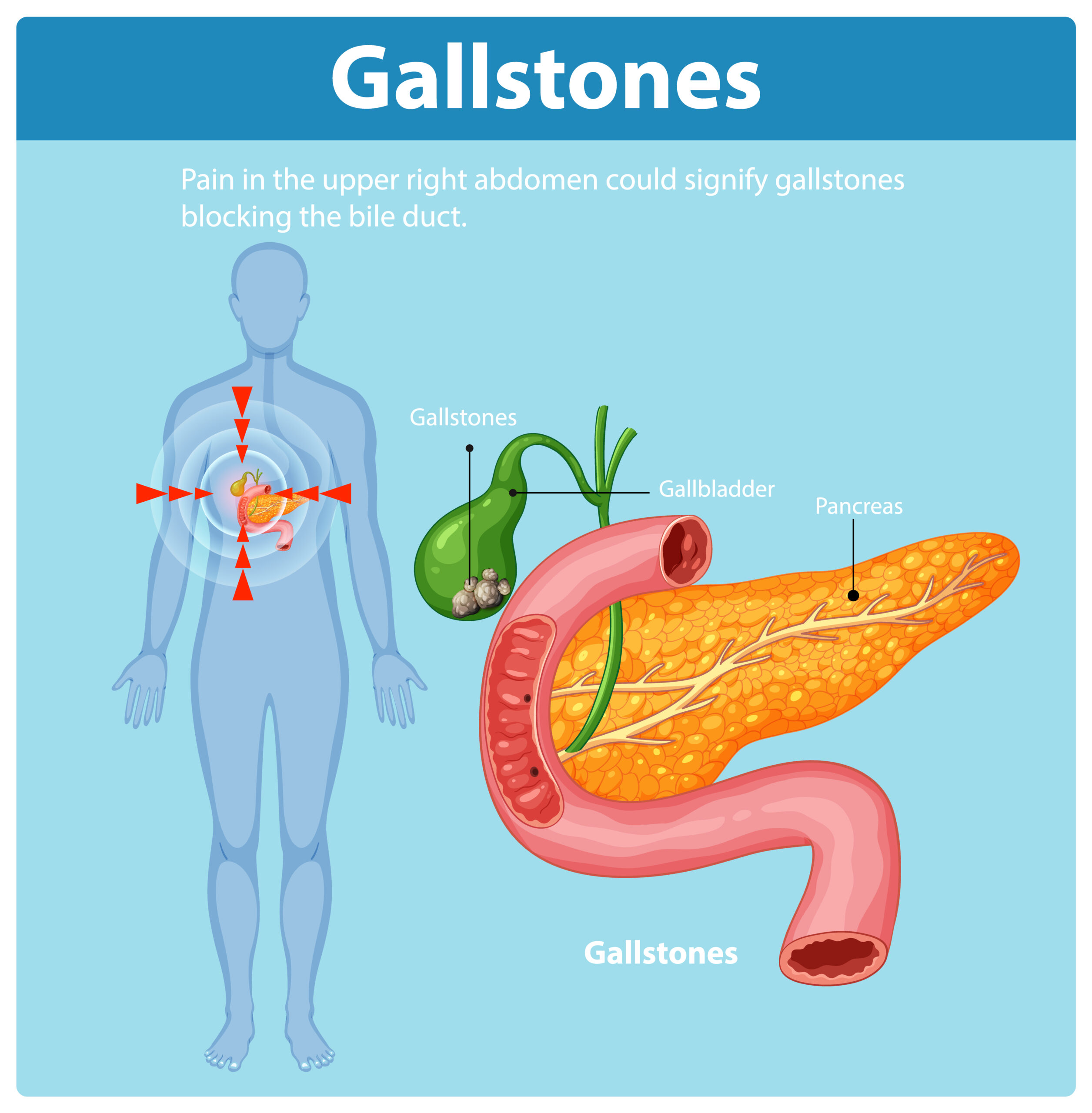 Gallbladder Stone Symptoms, Causes, and Treatment | Gallstones ...