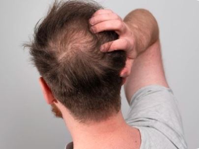 Hair Fall in Men: Causes, Prevention Tips & Treatment Options - Health ...