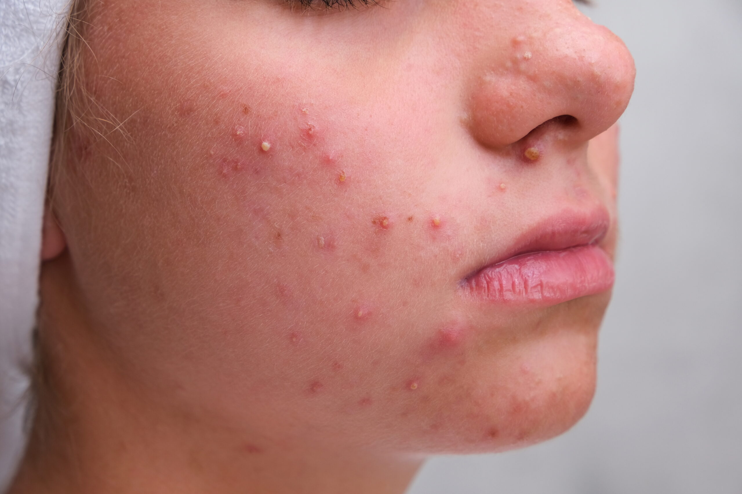 Is PCOS Causing Your Acne? Know the Symptoms, Causes & Treatment ...